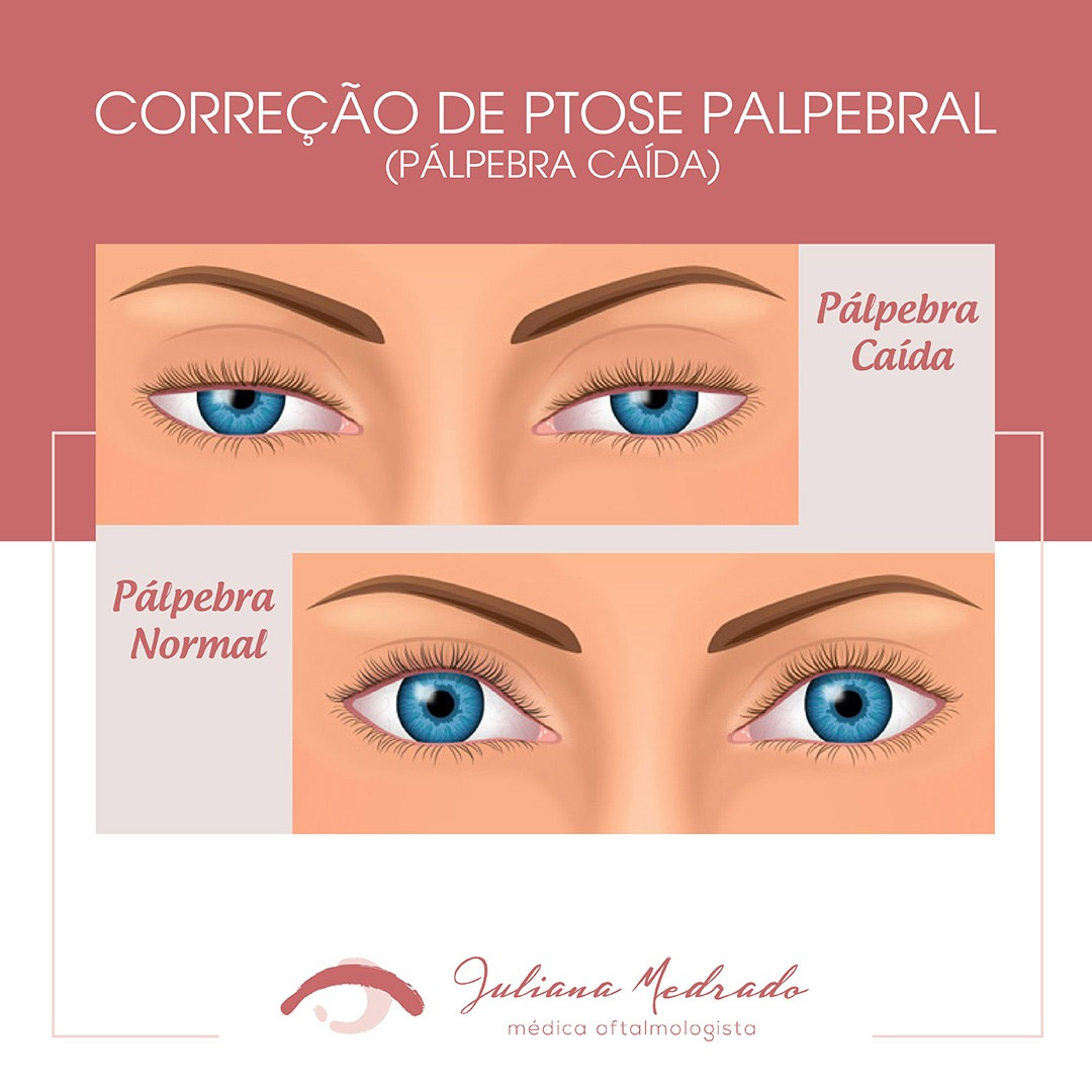 Correção de de ptose palpebral (pálpebra caída) – Dra. Juliana Medrado ...
